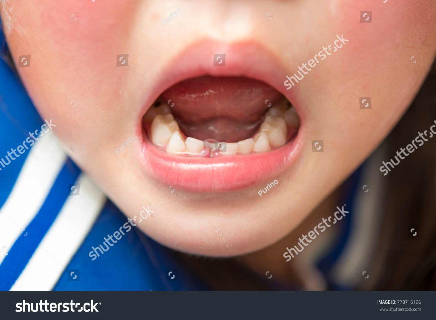 Tooth Missing Child Stock Photo (Edit Now) 778716196