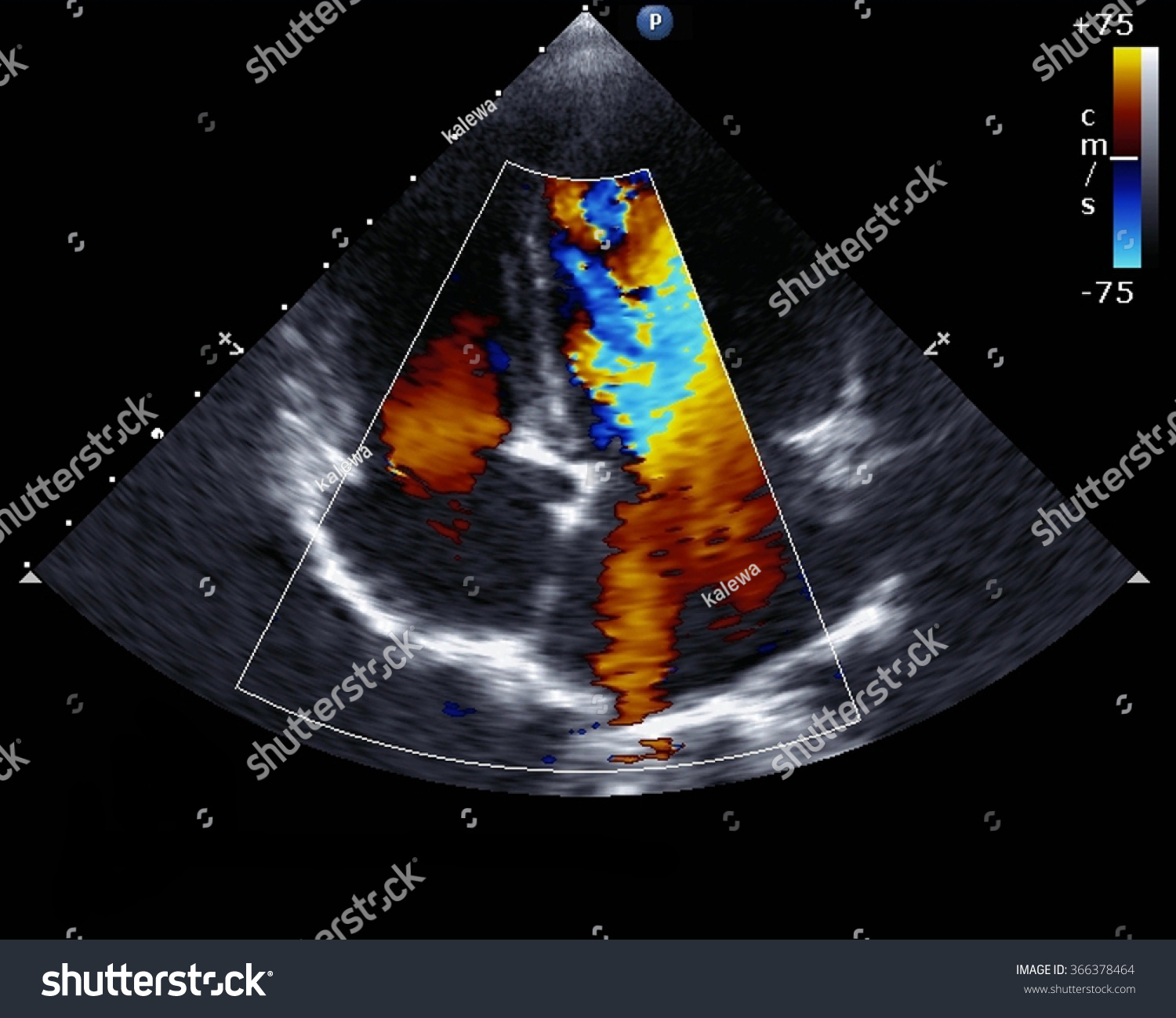 Transthoracic Twodimensional Color Doppler Echocardiography Stock Photo ... Transthoracic Twodimensional Color Doppler Echocardiography Stock Photo ...