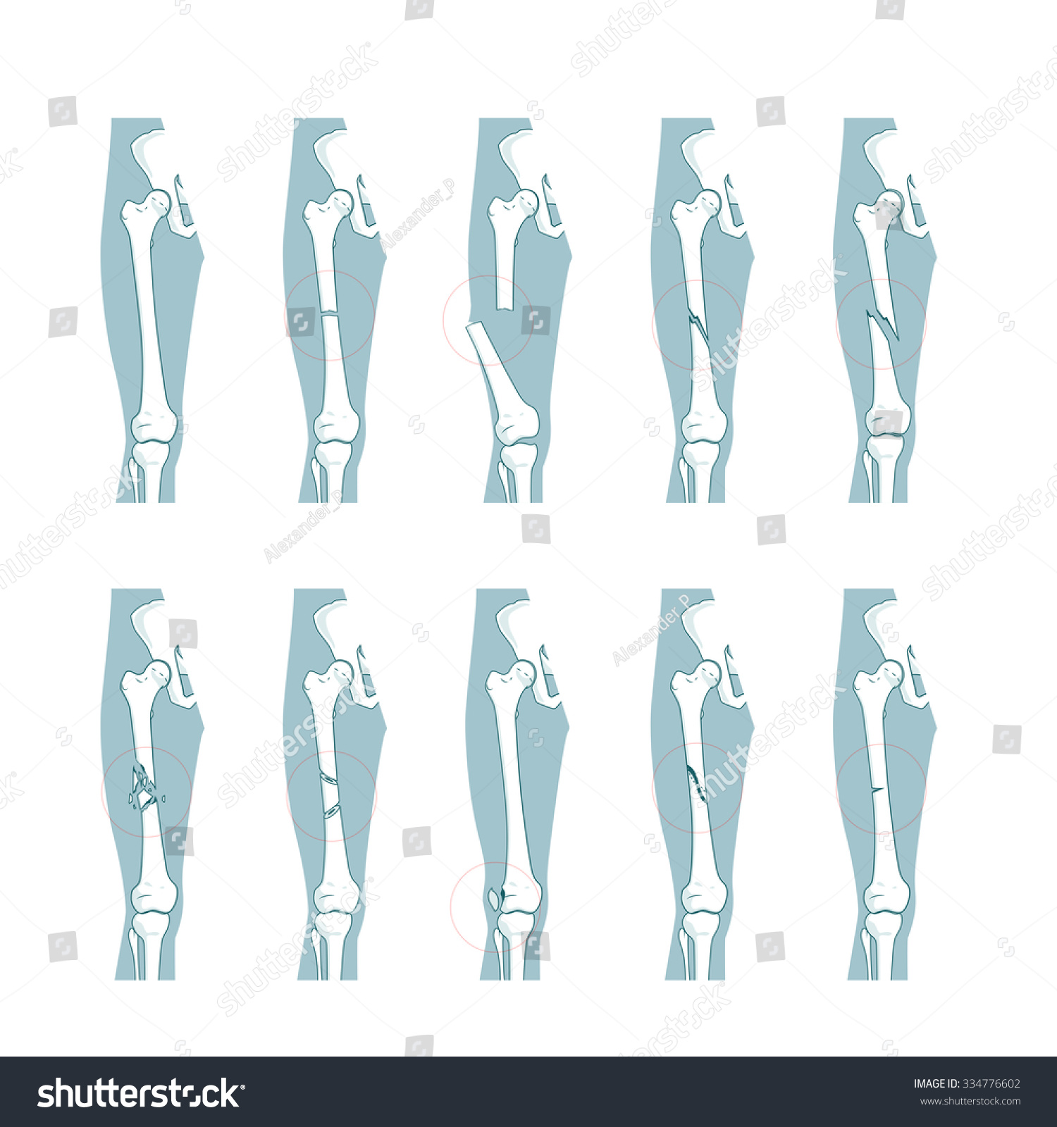 Ilustrasi Stok Types Bone Fractures Medical Skeleton Anatomy 334776602 ... Ilustrasi Stok Types Bone Fractures Medical Skeleton Anatomy 334776602 ...