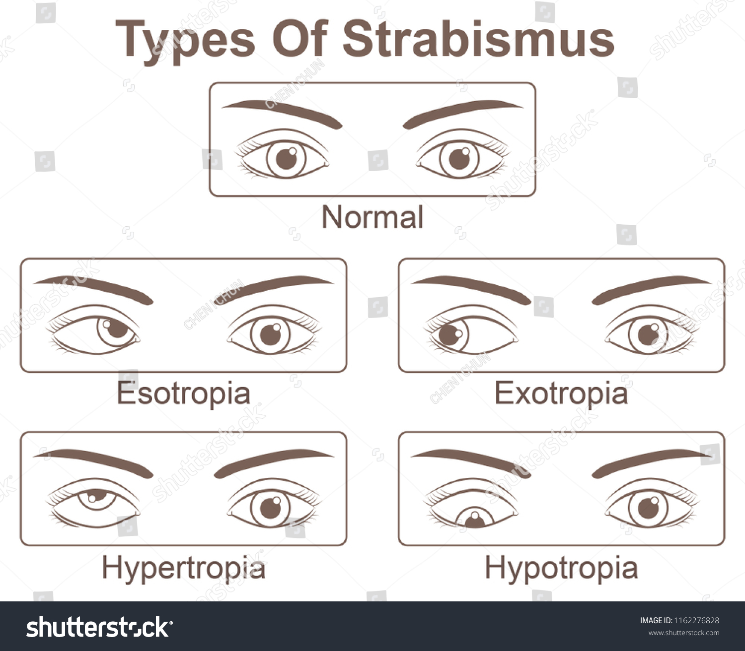 Types Strabismus Stock Illustration 1162276828 | Shutterstock Types Strabismus Stock Illustration 1162276828 | Shutterstock