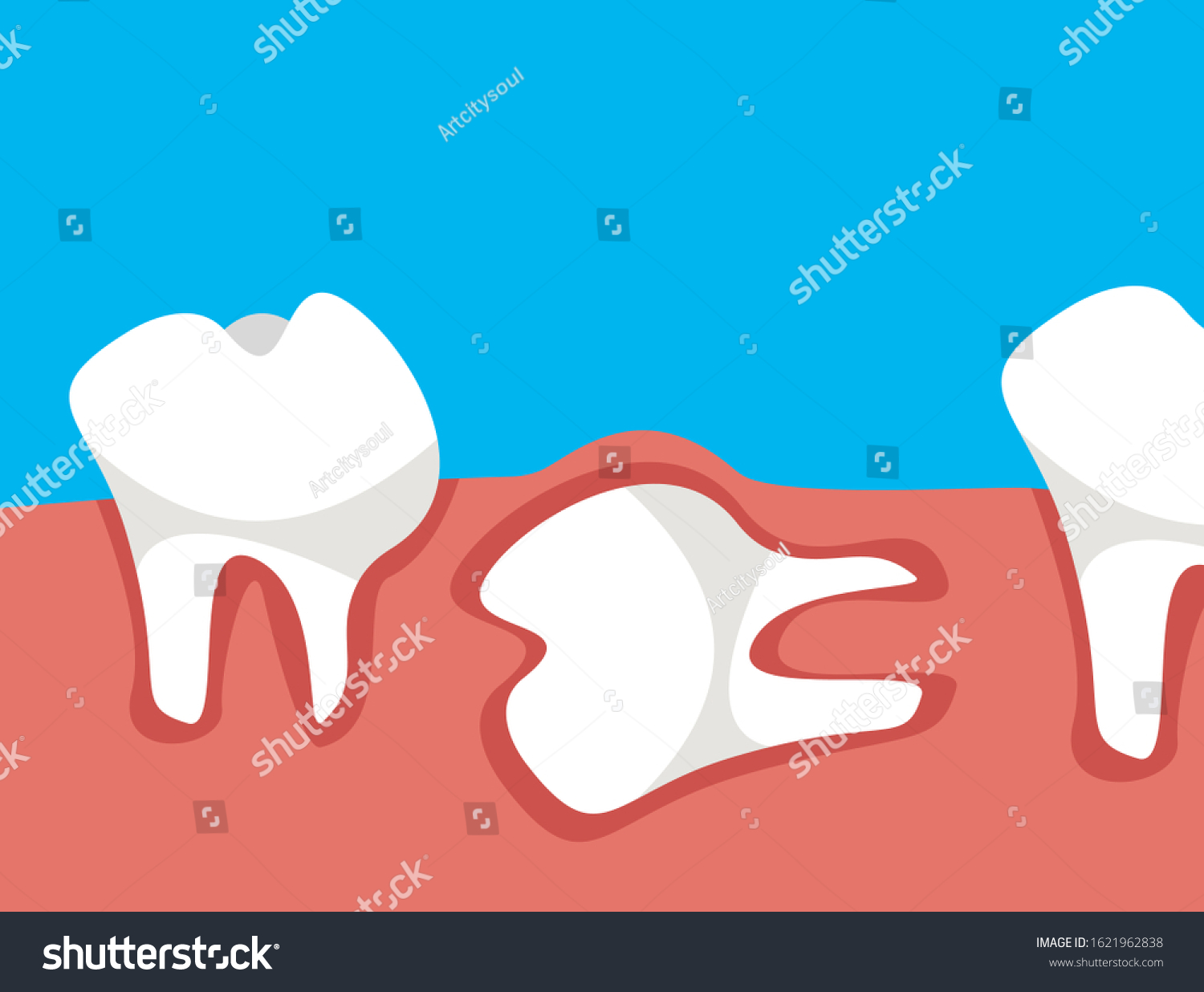 Tooth Horizontal Impactioncartoon Vector Illustration: เวกเตอร์สต็อก ...