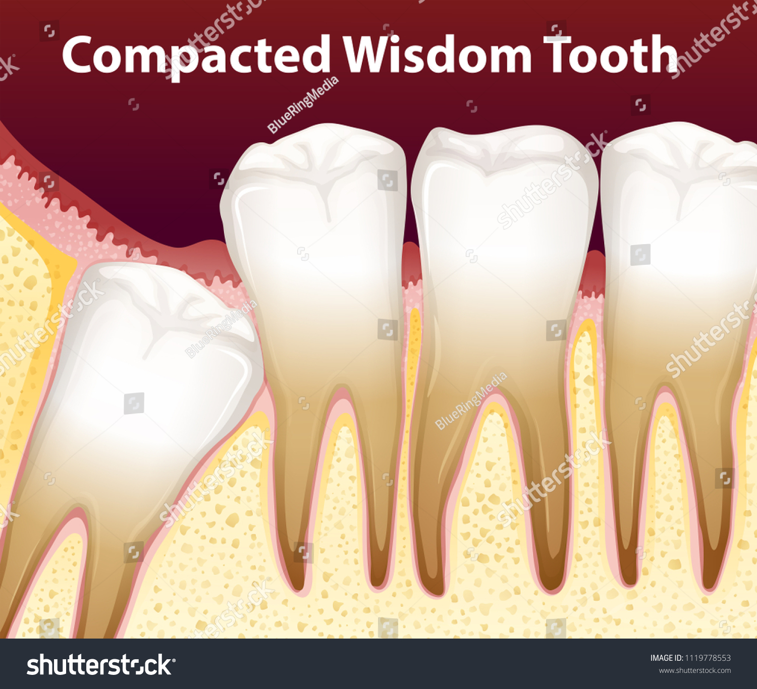 Compacted Wisdom Tooth Illustration Stock Vector (Royalty Free ...