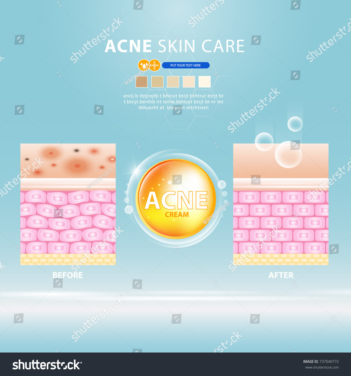 Acne Skin Spot Pimple Problem Vector Stock Vector (Royalty Free ...