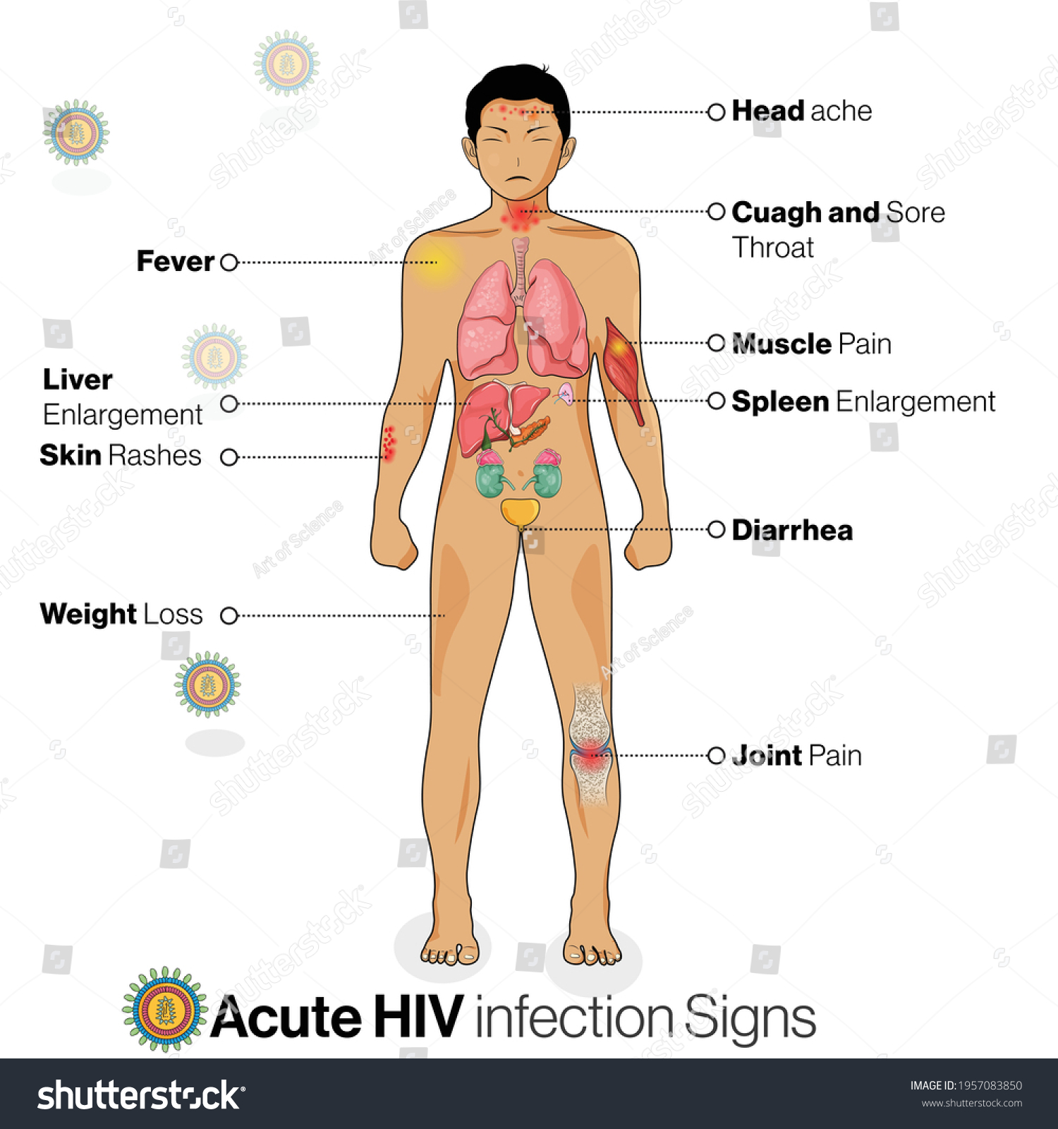Acute Hiv Infection Signs Symptoms Human Stock Vector Royalty Free