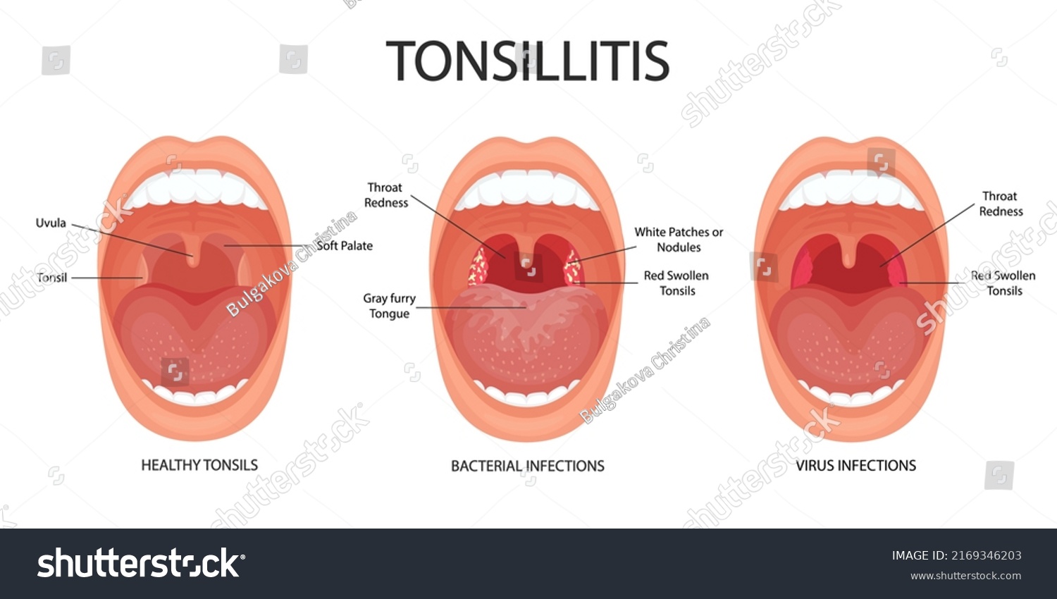 Angina Pharyngitis Tonsillitis Tonsillitis Bacterial Viral Vetor Stock Livre De Direitos