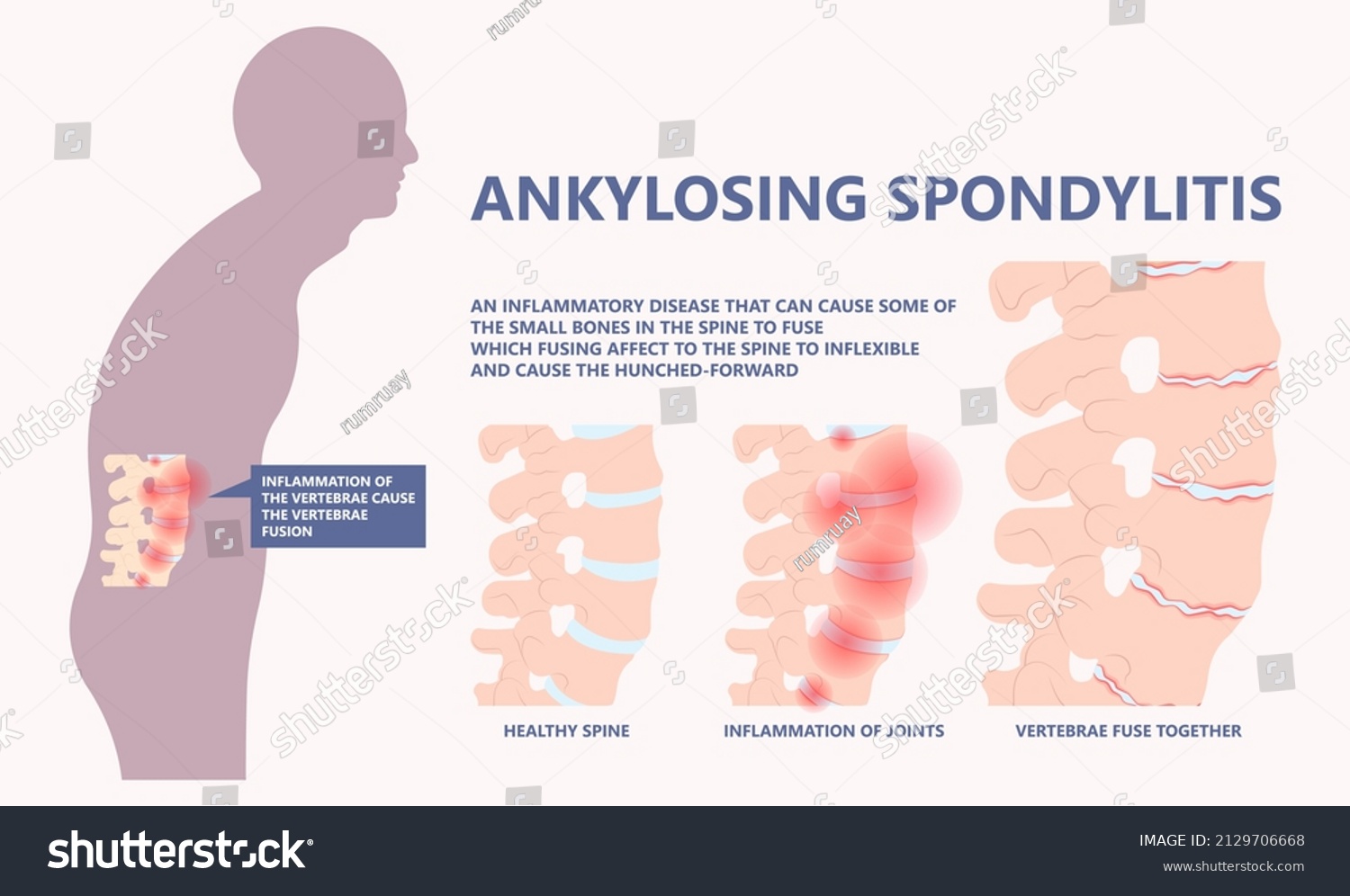 Ankylosing Spondylitis Osteoporosis Skeletal Pelvis Stiffness Vetor Stock Livre De Direitos