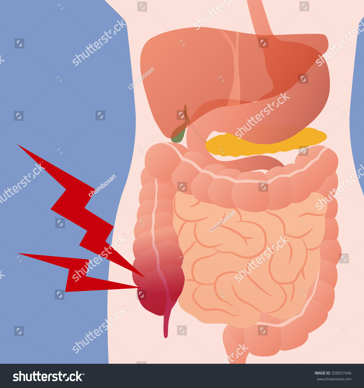Vektor Stok Appendicitis Human Digestive Organs Vector Illustration ...