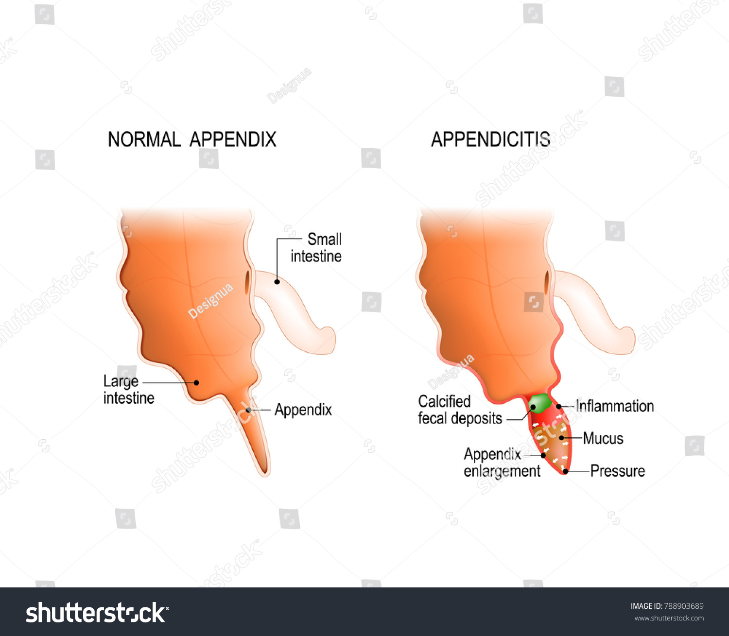 1 imagens de Appendicoliths Imagens, fotos stock e vetores | Shutterstock