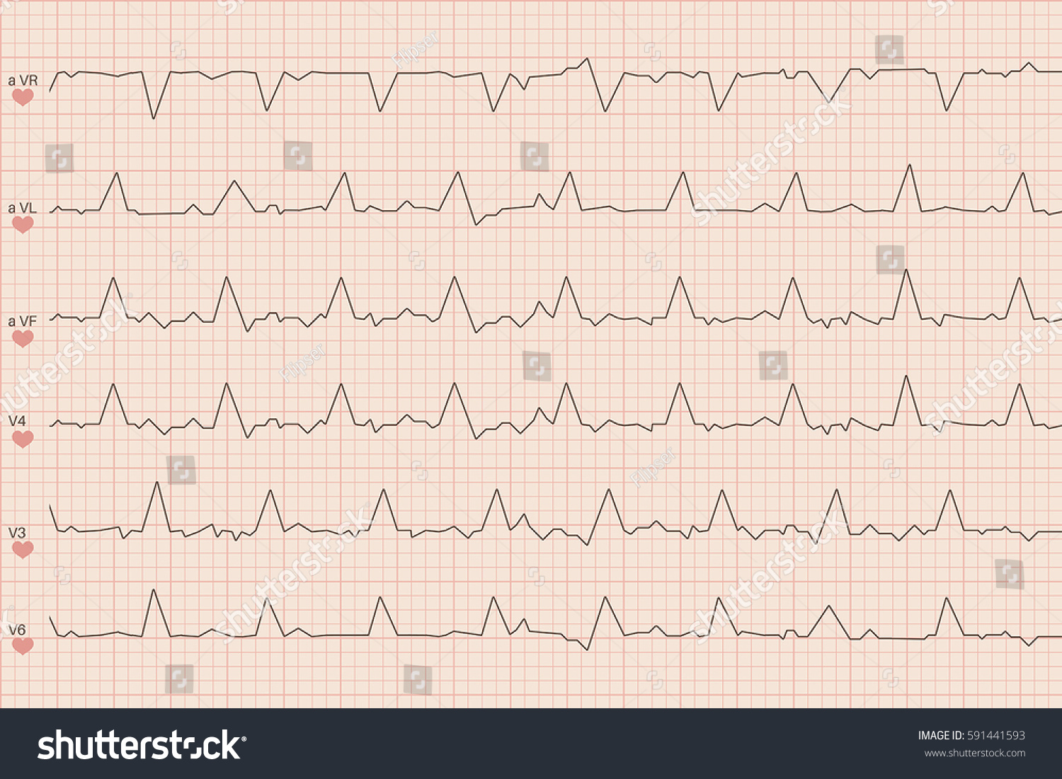 Arrhythmia Electrocardiogram Sheet Vector Illustration Stock Vector ...