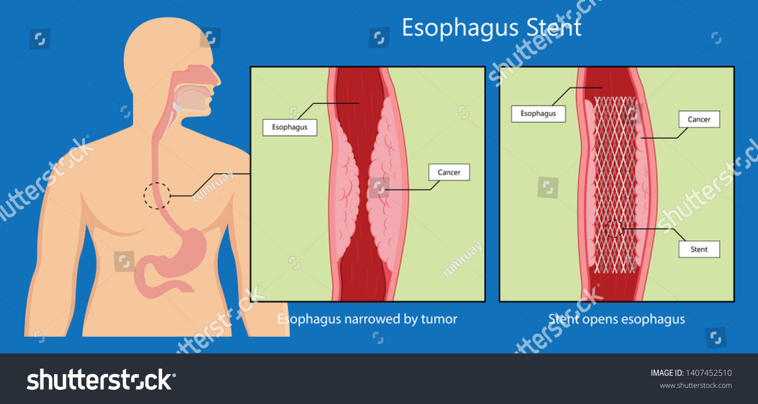Vektor Stok Barium Swallow Study Test Diagnose Barretts (Tanpa Royalti ... Vektor Stok Barium Swallow Study Test Diagnose Barretts (Tanpa Royalti ...