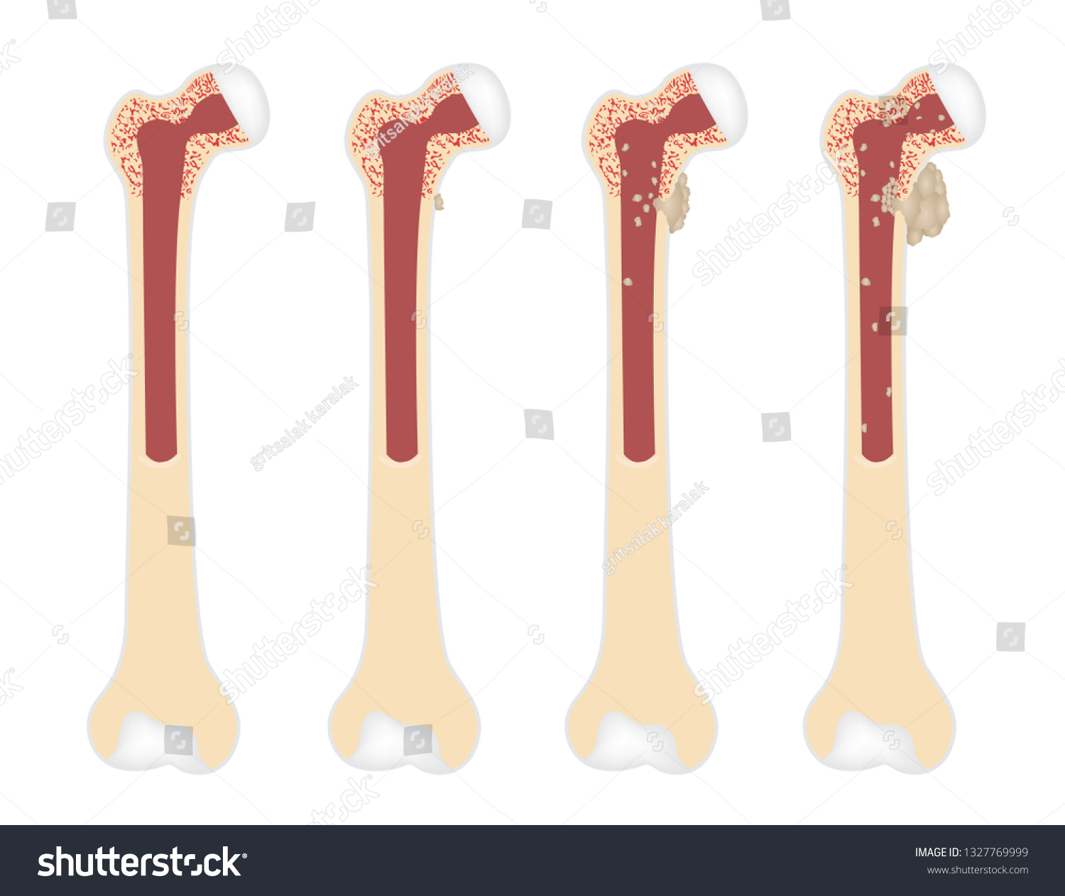 1,119 Bone tumor Stock Vectors, Images & Vector Art | Shutterstock