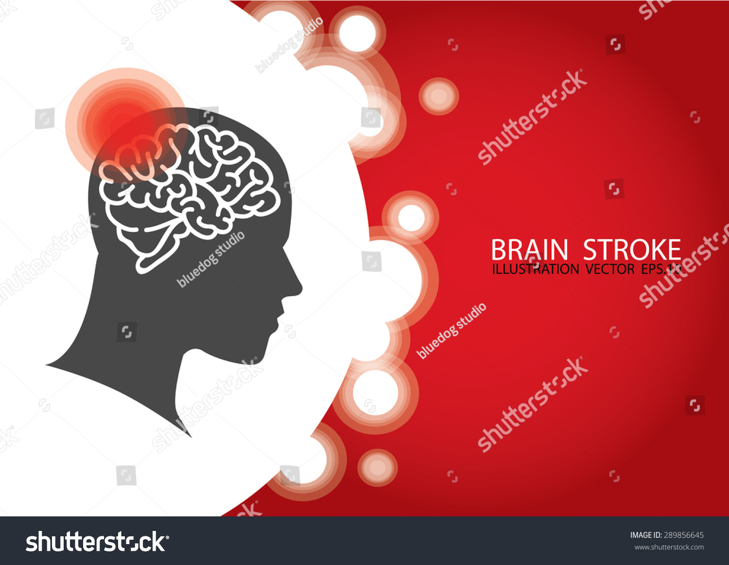 Brain Stroke Stock Vector (Royalty Free) 289856645 - Shutterstock