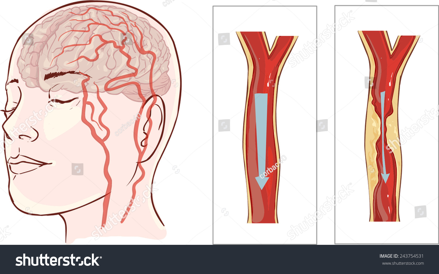 Brain Stroke Cerebral Infarction Stock Vector (Royalty Free) 243754531