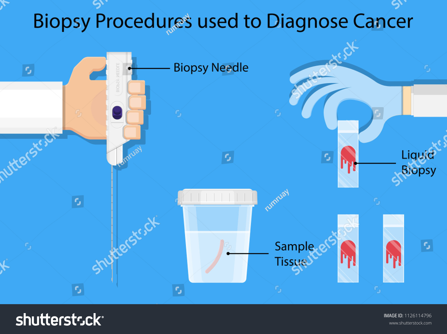 Breast Biopsy Medical Fine Needle Aspiration Vetor Stock Livre De