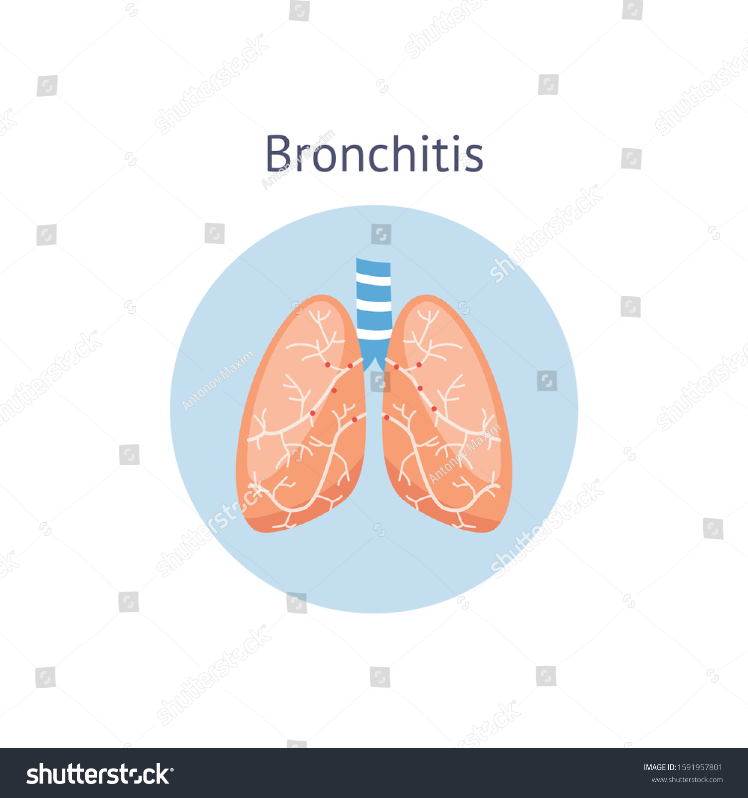 Bronchitis Lung Disease Illness Medical Anatomical Stock Vector