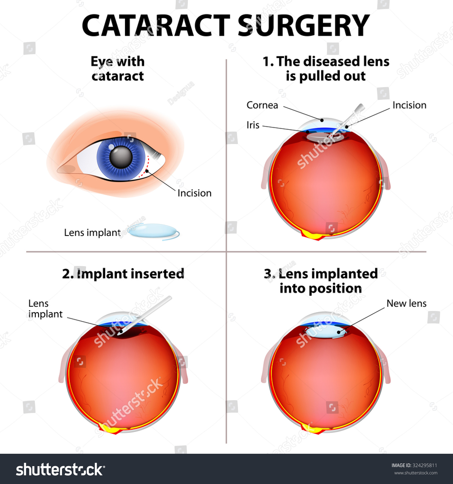 Extracapsular Cataract Extraction Illustration