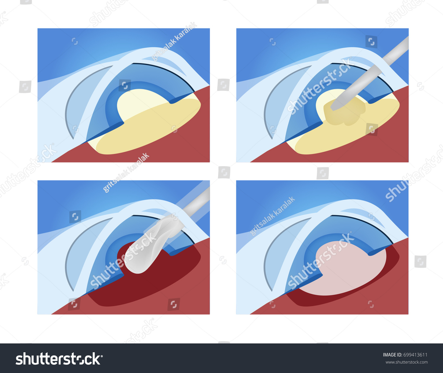 Cataracts Surgery Vector Eye Stock Vector (Royalty Free) 699413611