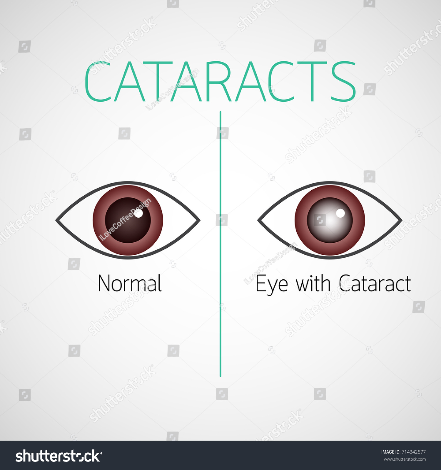Cataracts Vector Icon Illustration Stock Vector (Royalty Free ...