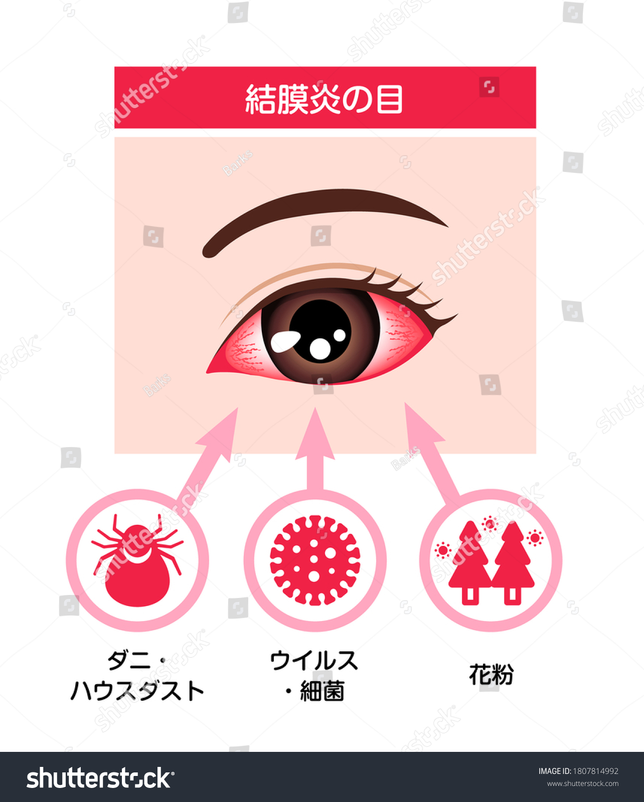 Causes Conjunctivitis Pink Eye Vector Illustration Stock-vektor ... Causes Conjunctivitis Pink Eye Vector Illustration Stock-vektor ...