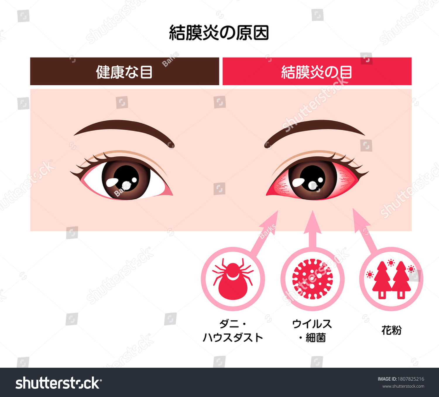 Causes Conjunctivitis Pink Eye Vector Illustration 库存矢量图(免版税)1807825216 ... Causes Conjunctivitis Pink Eye Vector Illustration 库存矢量图(免版税)1807825216 ...