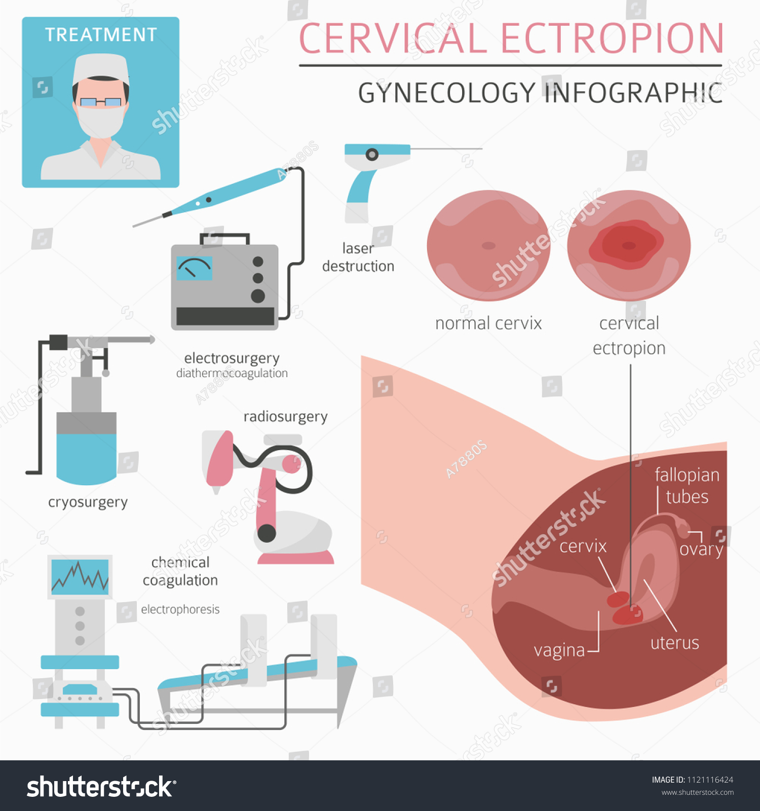 Cervical Ectropion Ginecological Medical Desease Infographic Stock