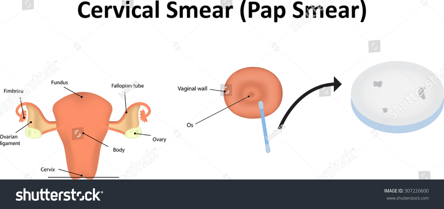 Cervical Smear Pap Smear: เวกเตอร์สต็อก (ปลอดค่าลิขสิทธิ์) 307220600