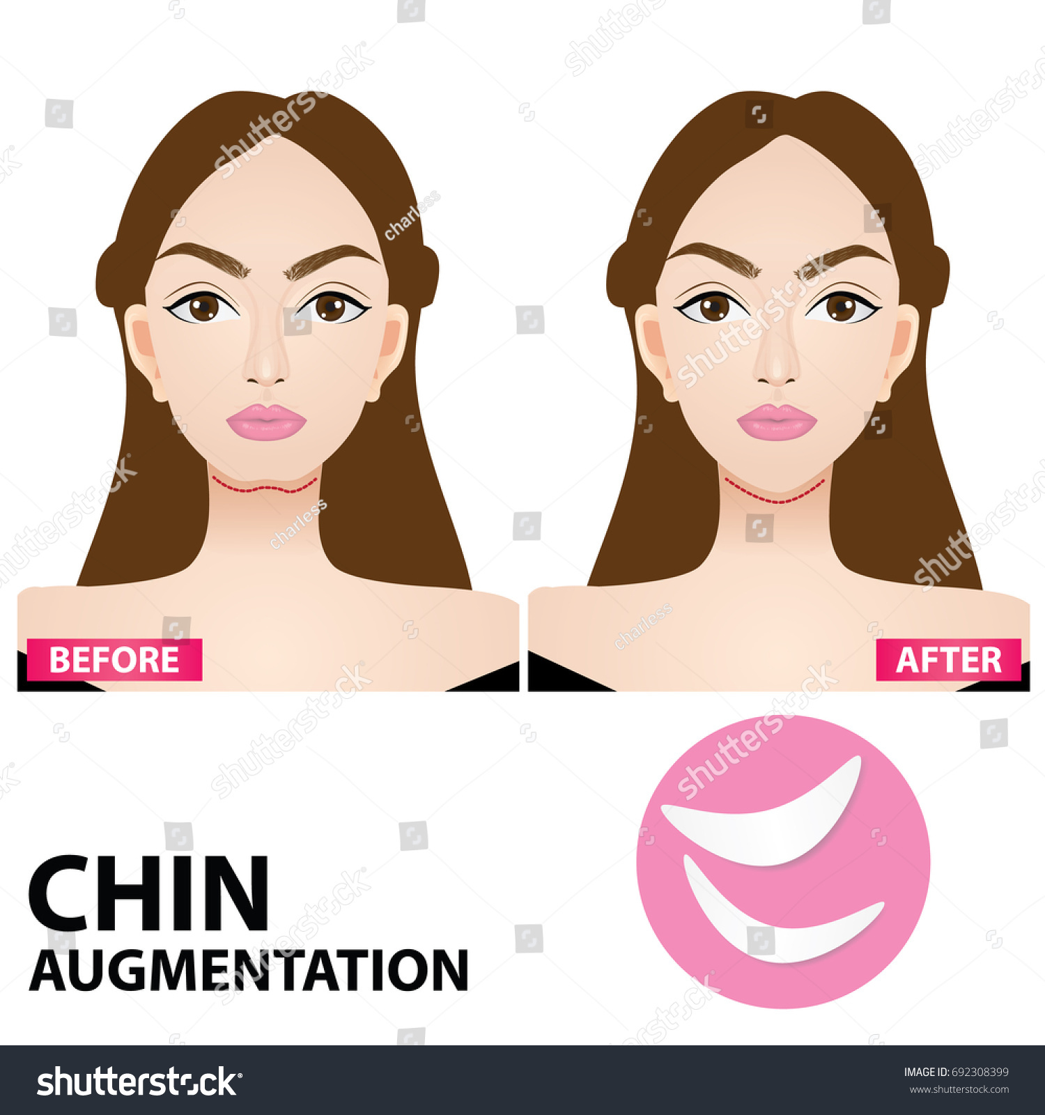 Chin Augmentation Before After Vector Illustration 库存矢量图（免版税）692308399 ...
