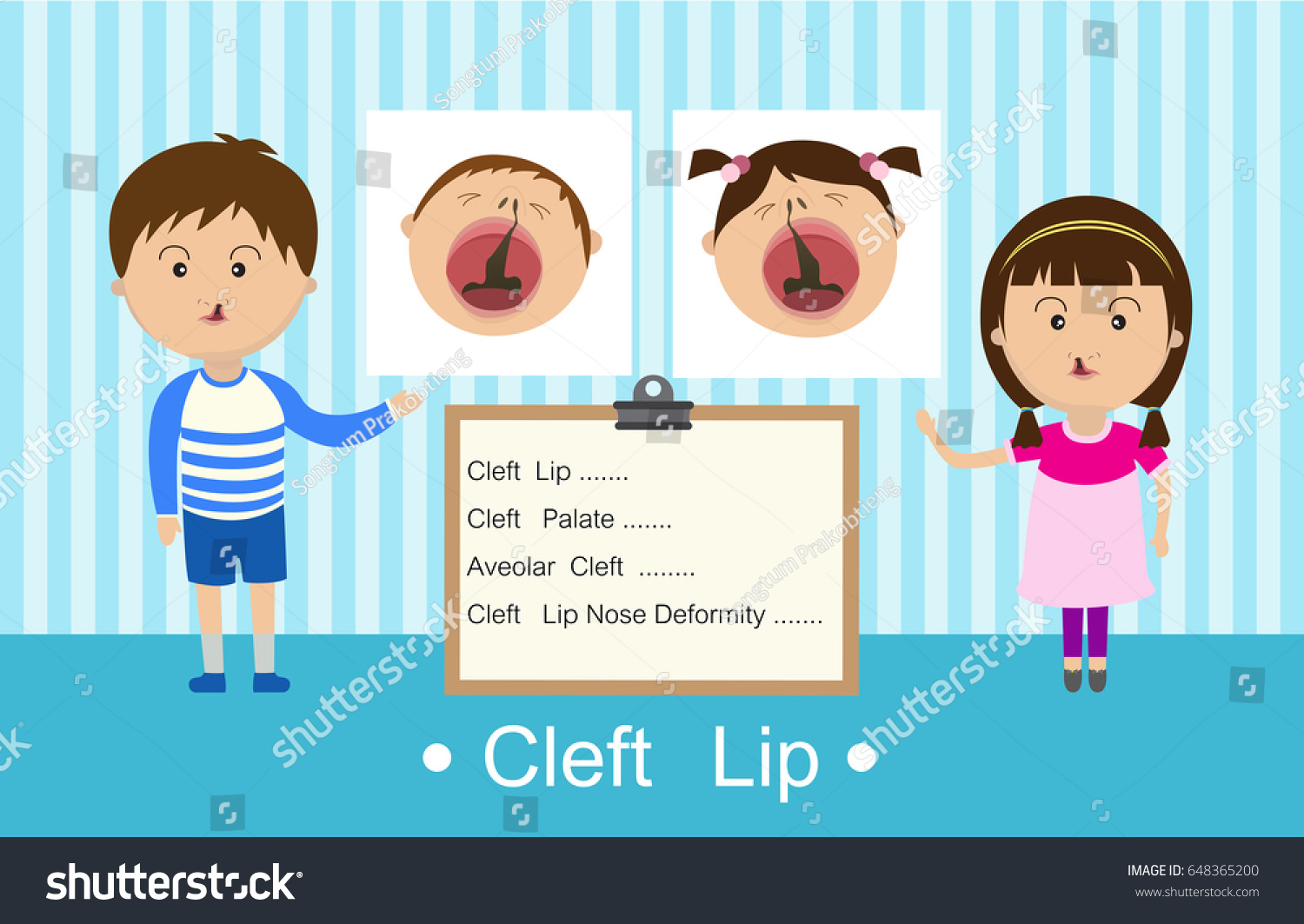Cleft Lip Vector Illustration Stock Vector (Royalty Free) 648365200 ...