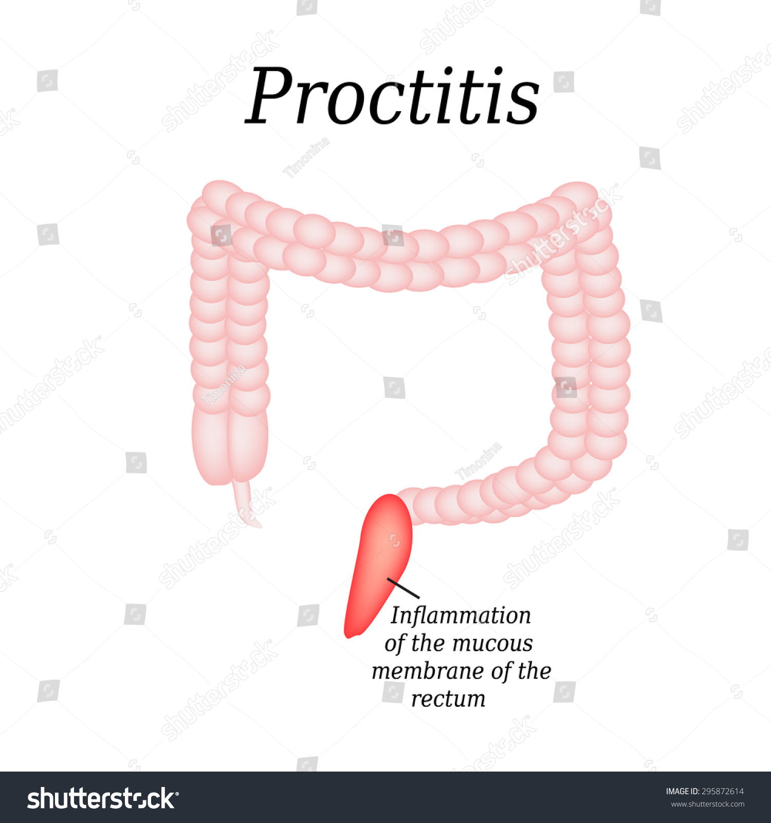 Colon Proctitis Vector Illustration On Isolated Stock Vector (Royalty ...