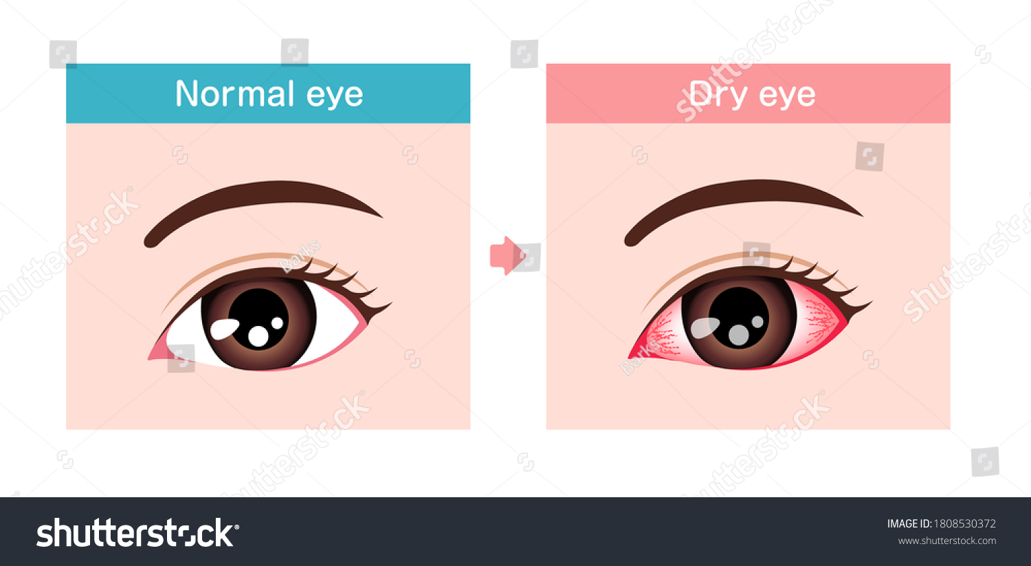4,247 Dry eye vector Images, Stock Photos & Vectors | Shutterstock