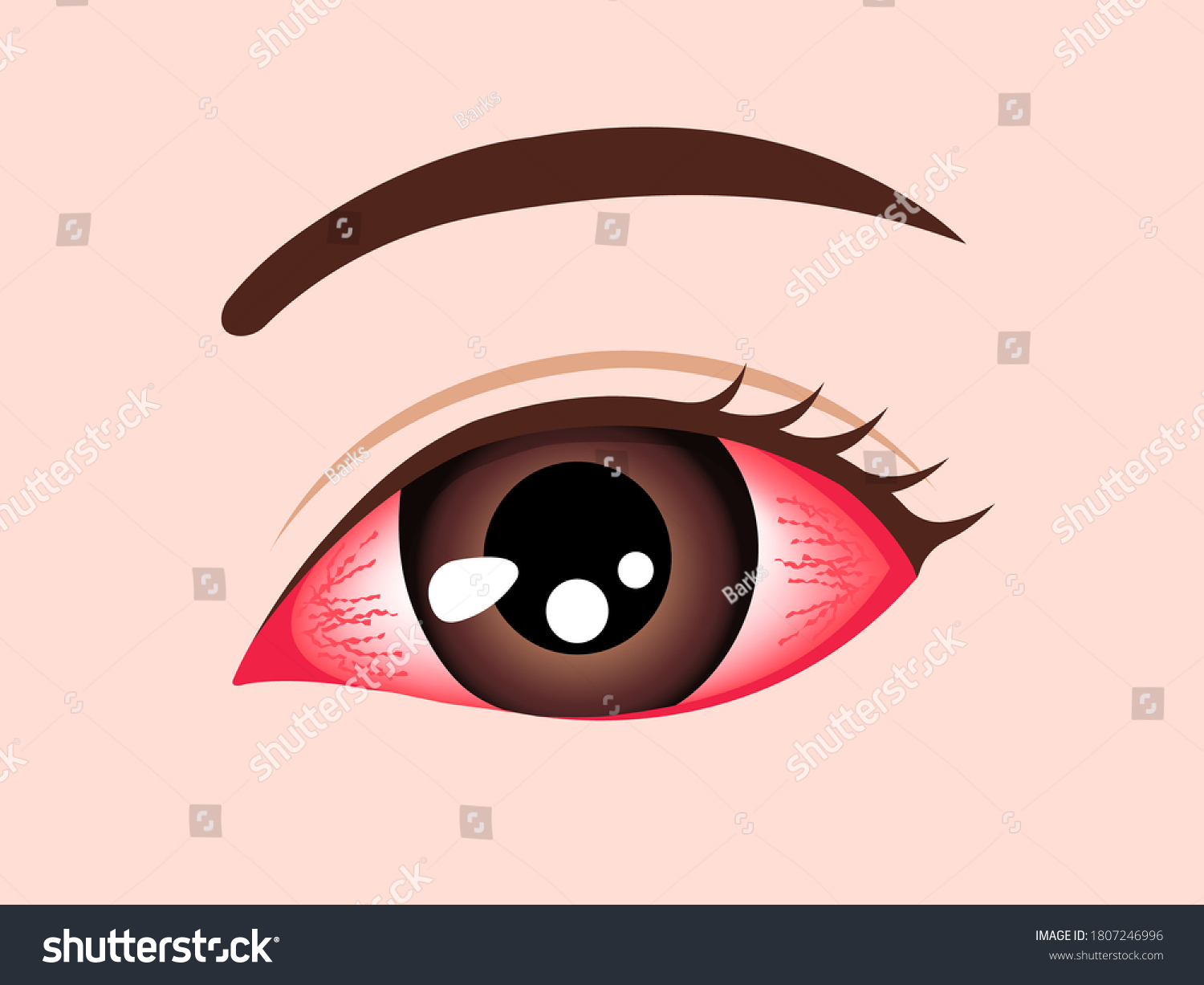 Conjunctivitis Pink Eye Vector Illustration Stock Vector (Royalty Free ...