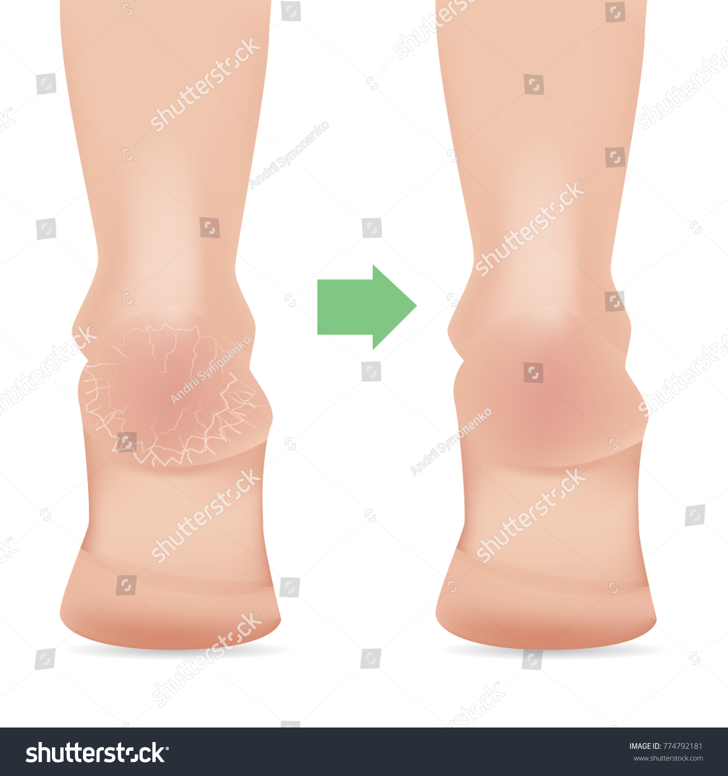 Cracked Heels On White Background Vector Stock Vector (Royalty Free ...
