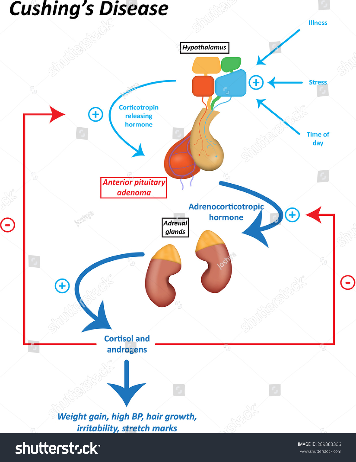 Cushings Disease Stock Vector (Royalty Free) 289883306 - Shutterstock