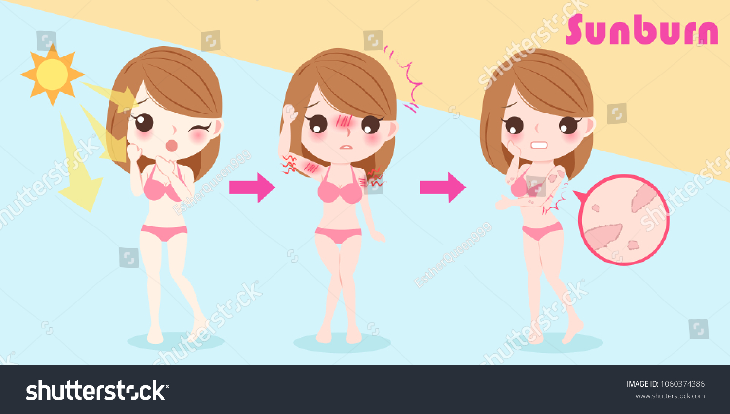 Cute Cartoon Woman Sunburn Problem Summer Stock Vector Royalty Free