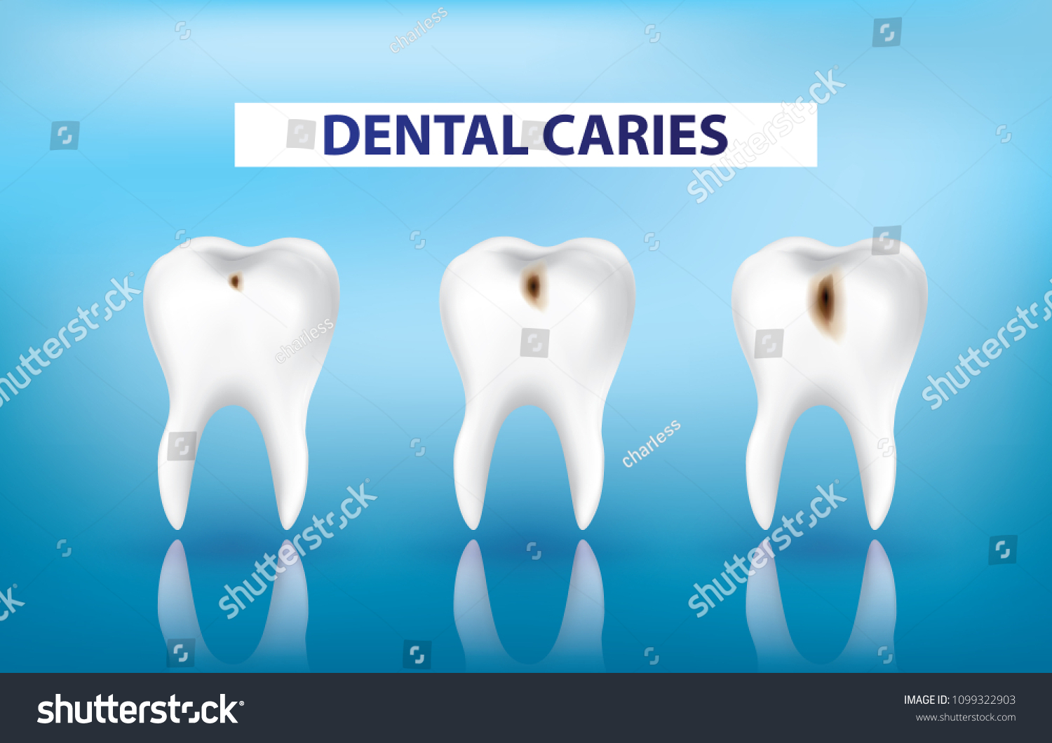Dental Caries Vector Illustration: เวกเตอร์สต็อก (ปลอดค่าลิขสิทธิ์ ...