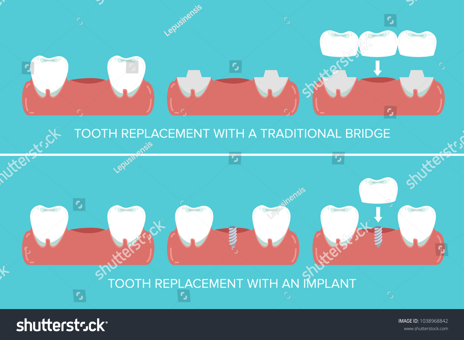 Dental Implants Versus Fixed Bridges Stock Vector (Royalty Free) 1038968842
