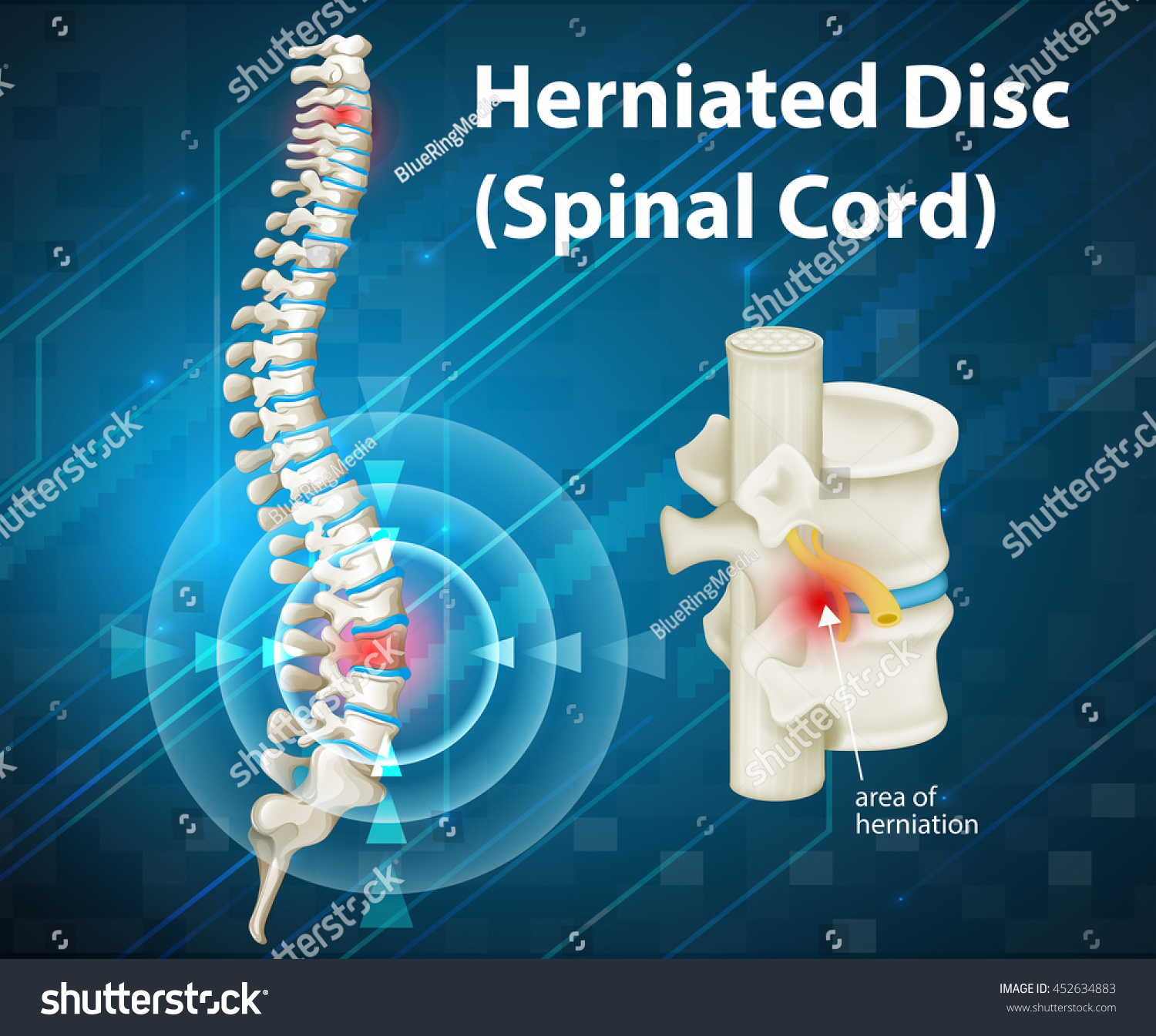 Diagram Showing Herniated Disc Illustration Stock Vector (Royalty Free ...