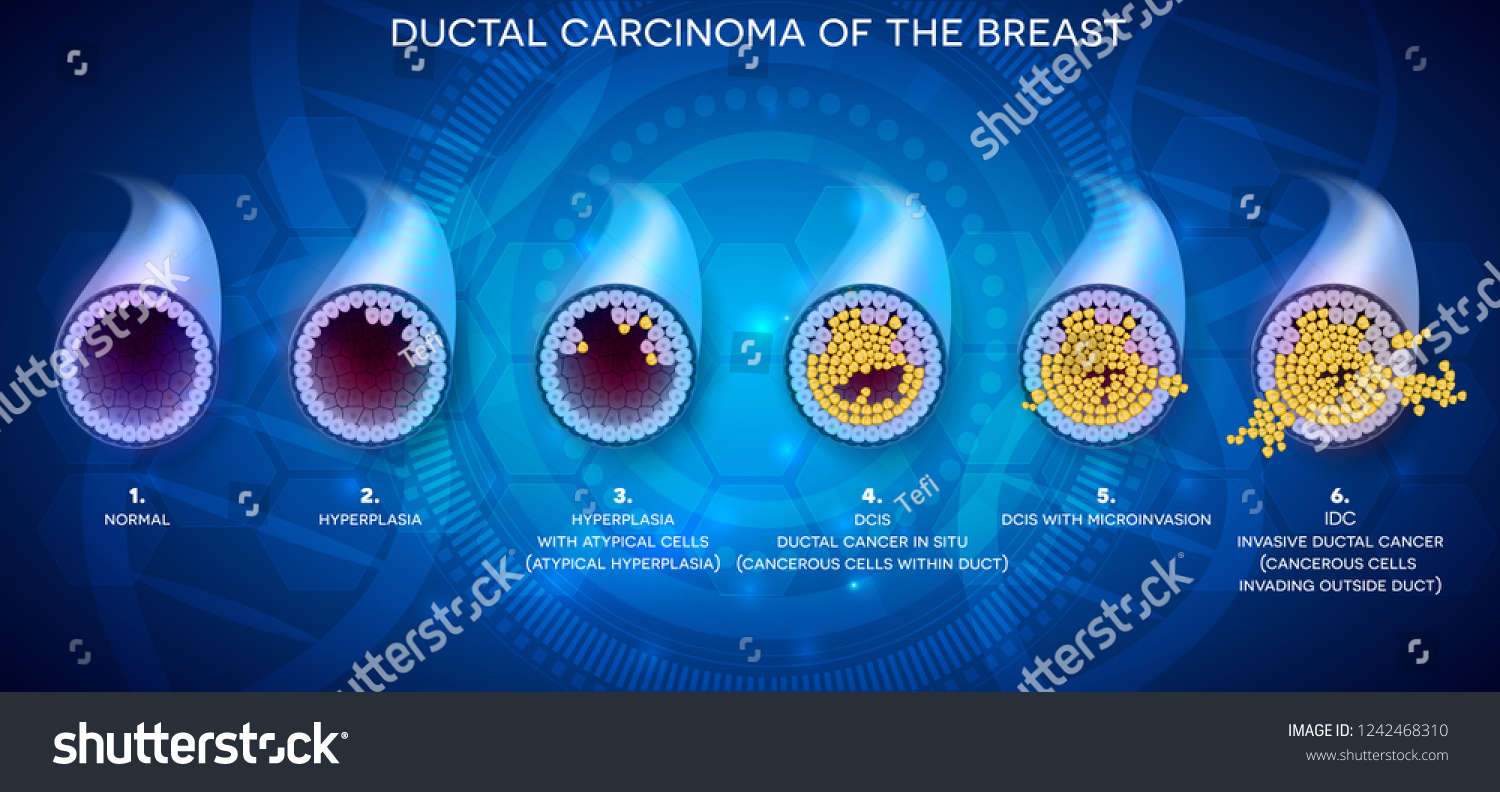 Ductal Carcinoma Breast Detailed Medical Illustration Stock Vector ... Ductal Carcinoma Breast Detailed Medical Illustration Stock Vector ...