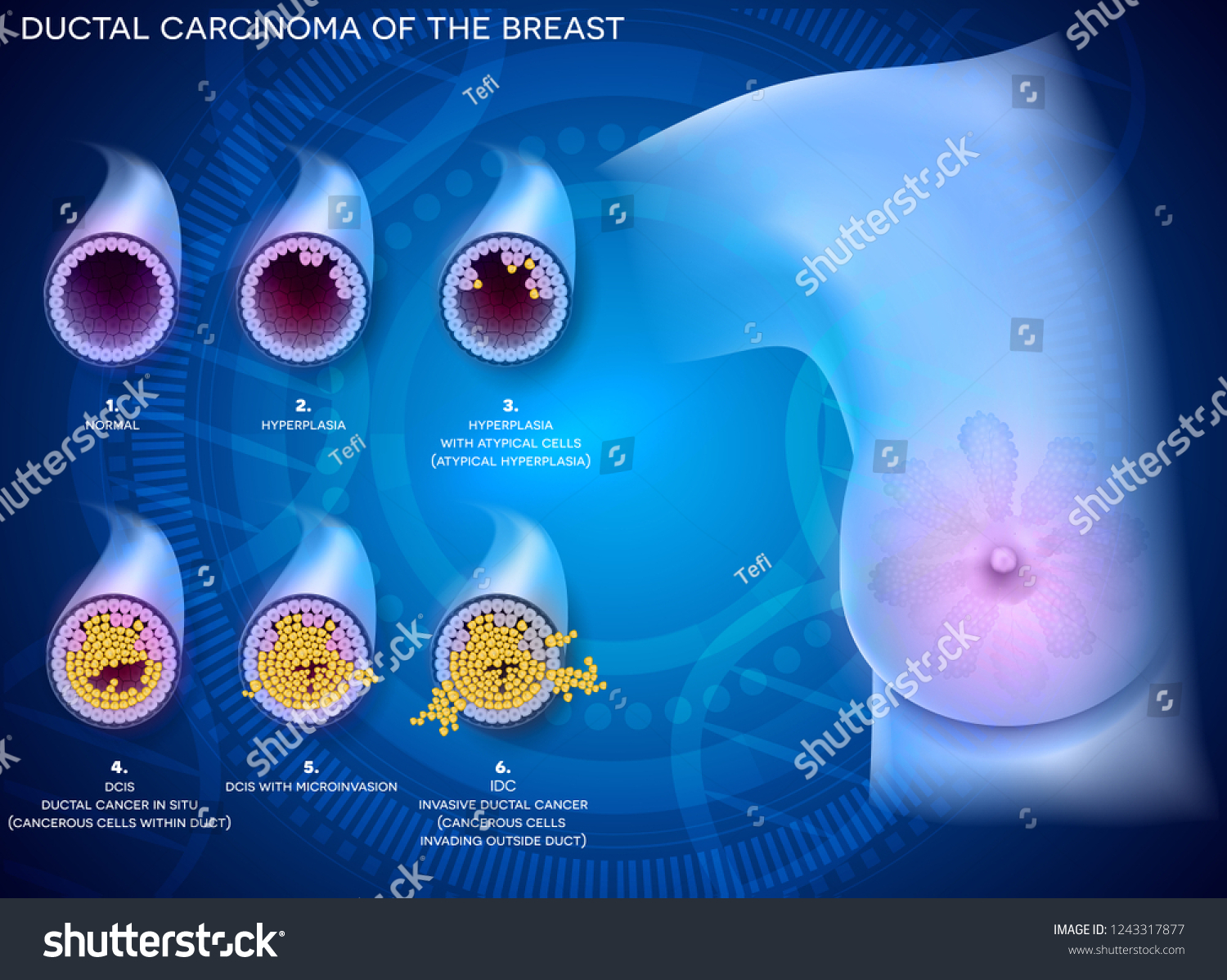 Ductal Carcinoma Breast Detailed Medical Illustration Stock Vector ... Ductal Carcinoma Breast Detailed Medical Illustration Stock Vector ...