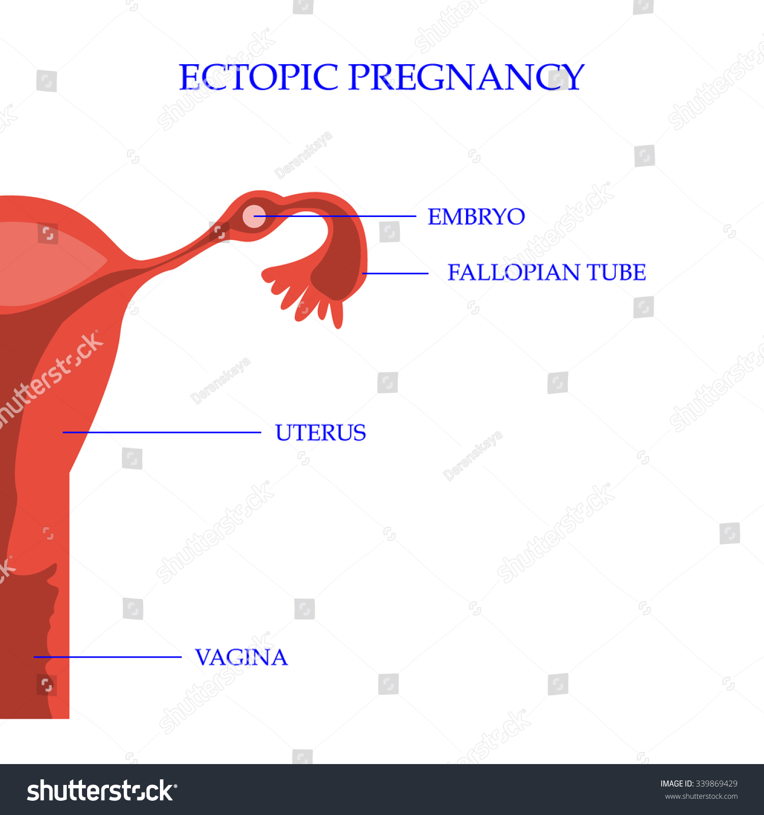 Vektor Stok Ectopic Pregnancy Concept Vector Illustration (Tanpa ...