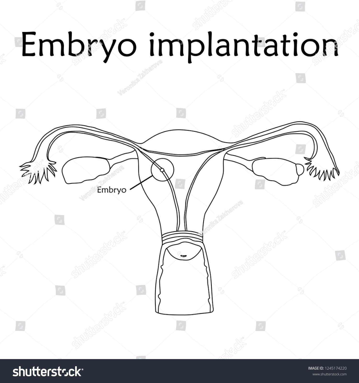 Embryo Implantation Fertilized Egg Uterus Womb เวกเตอร์สต็อก ปลอดค่าลิขสิทธิ์ 1245174220