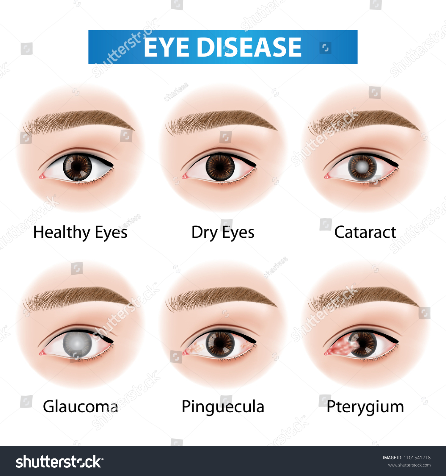 20,407 Eye disease Stock Vectors, Images & Vector Art | Shutterstock