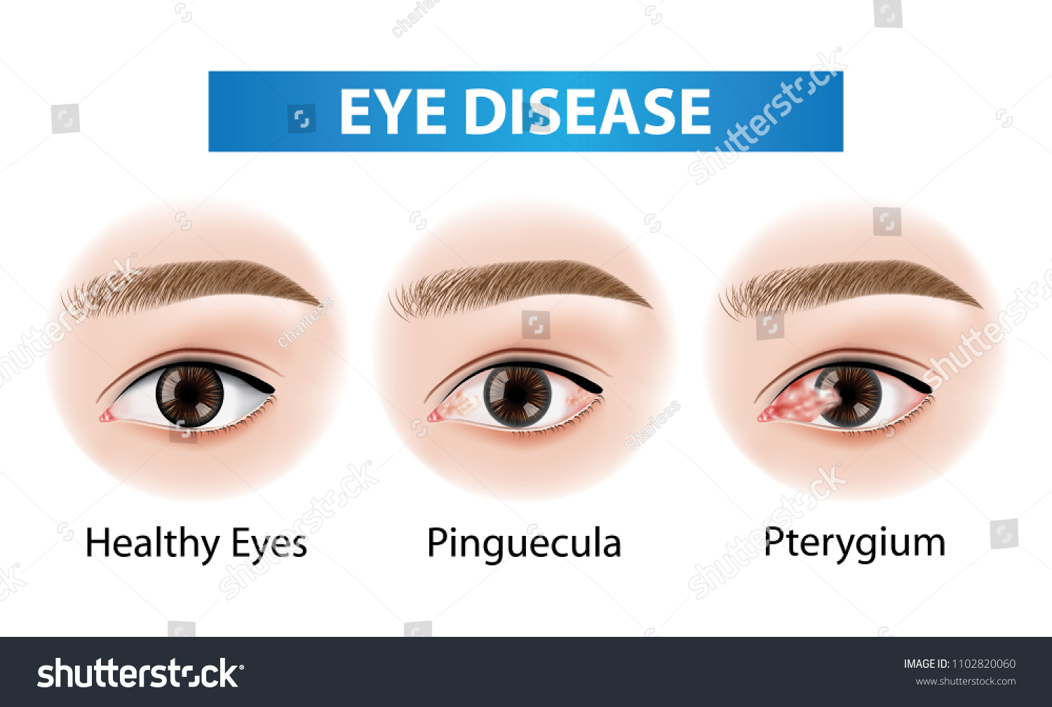 Eye Diseases Vector Illustration Stock Vector (Royalty Free) 1102820060