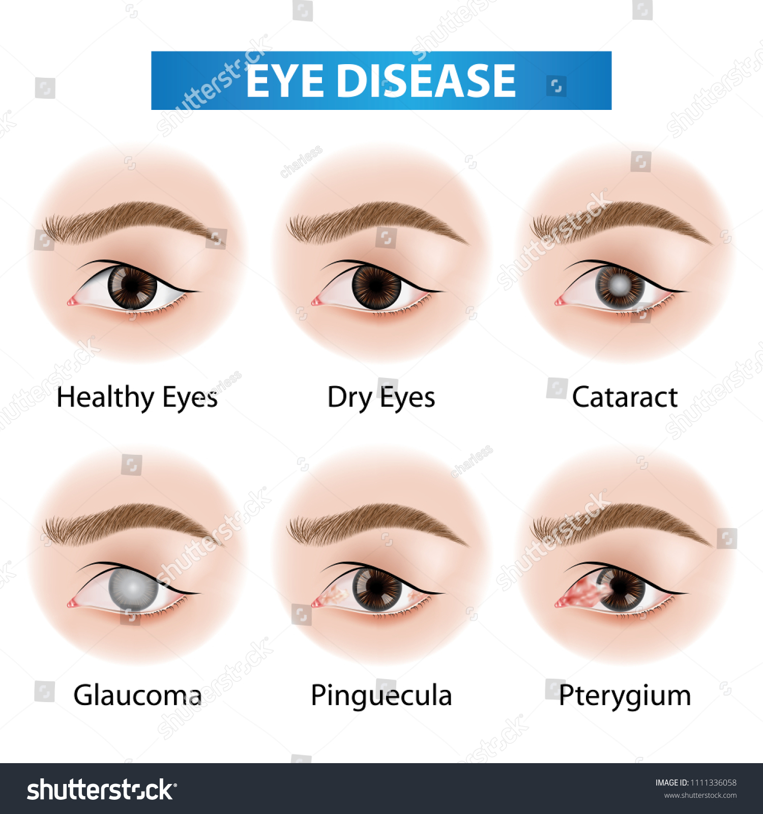 Eye Diseases Vector Illustration Stock Vector (Royalty Free) 1111336058