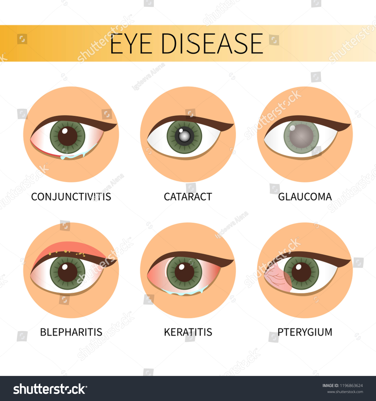 Eye Diseases Vector Illustration: เวกเตอร์สต็อก (ปลอดค่าลิขสิทธิ์ ...