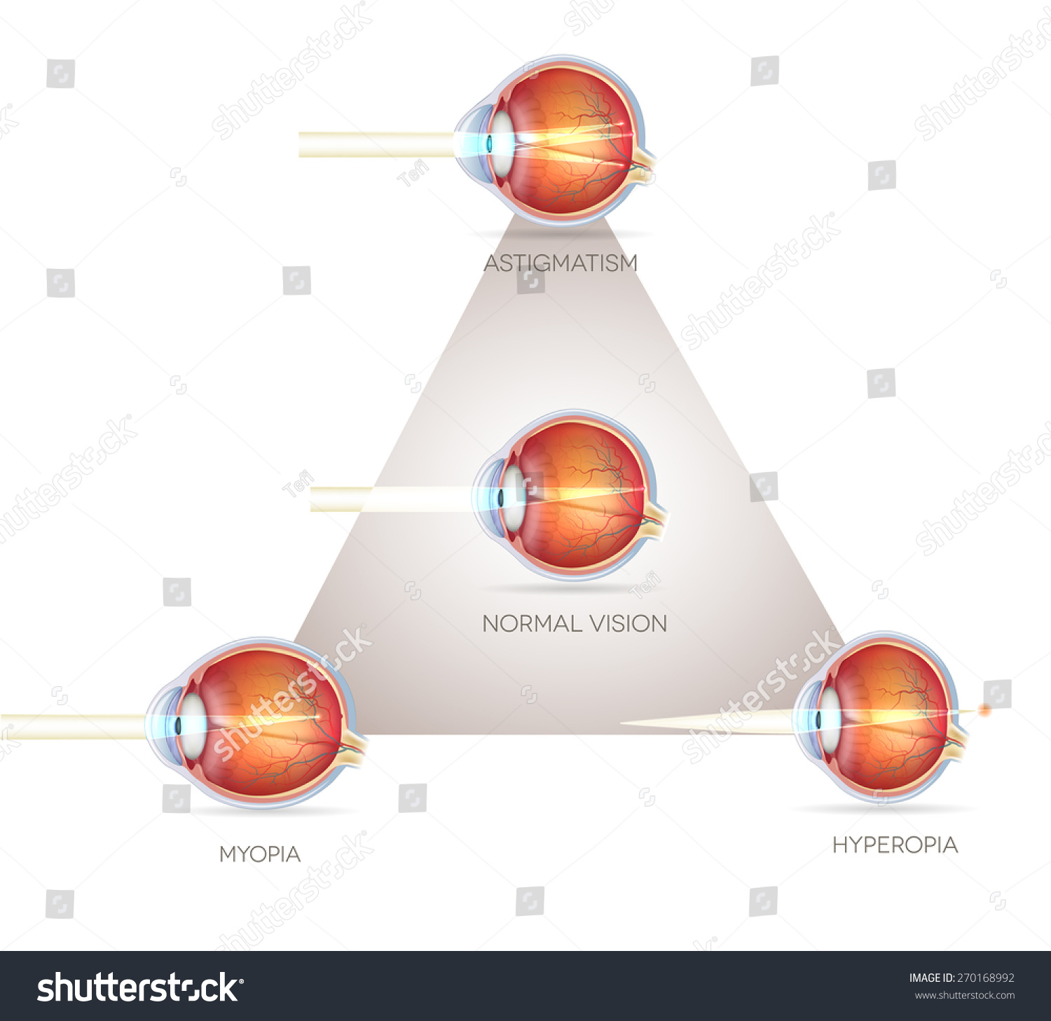 Eye Vision Triangle Vision Disorders Normal Stock Vector (Royalty Free ...