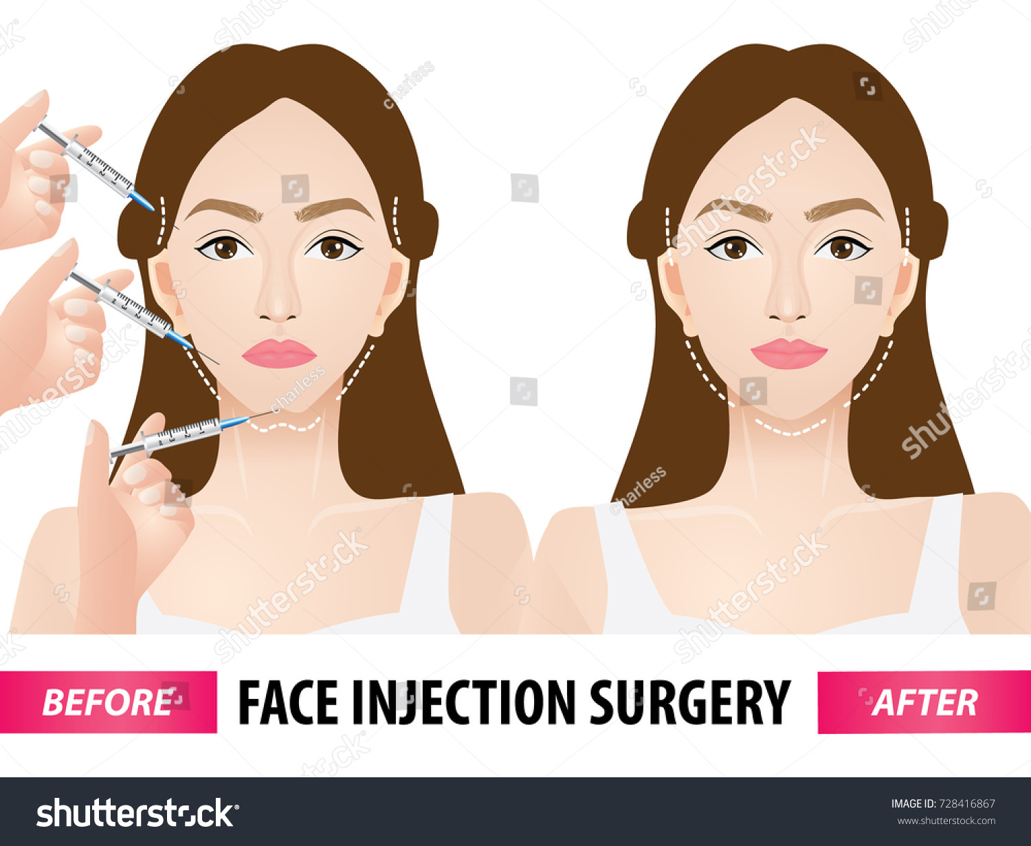 Face Injection Surgery Before After Vector: vetor stock (livre de ...