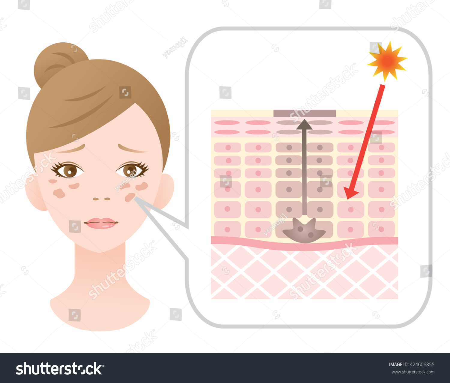 Facial Blotches Skin Mechanism Stock Vector (Royalty Free) 424606855 ... Facial Blotches Skin Mechanism Stock Vector (Royalty Free) 424606855 ...