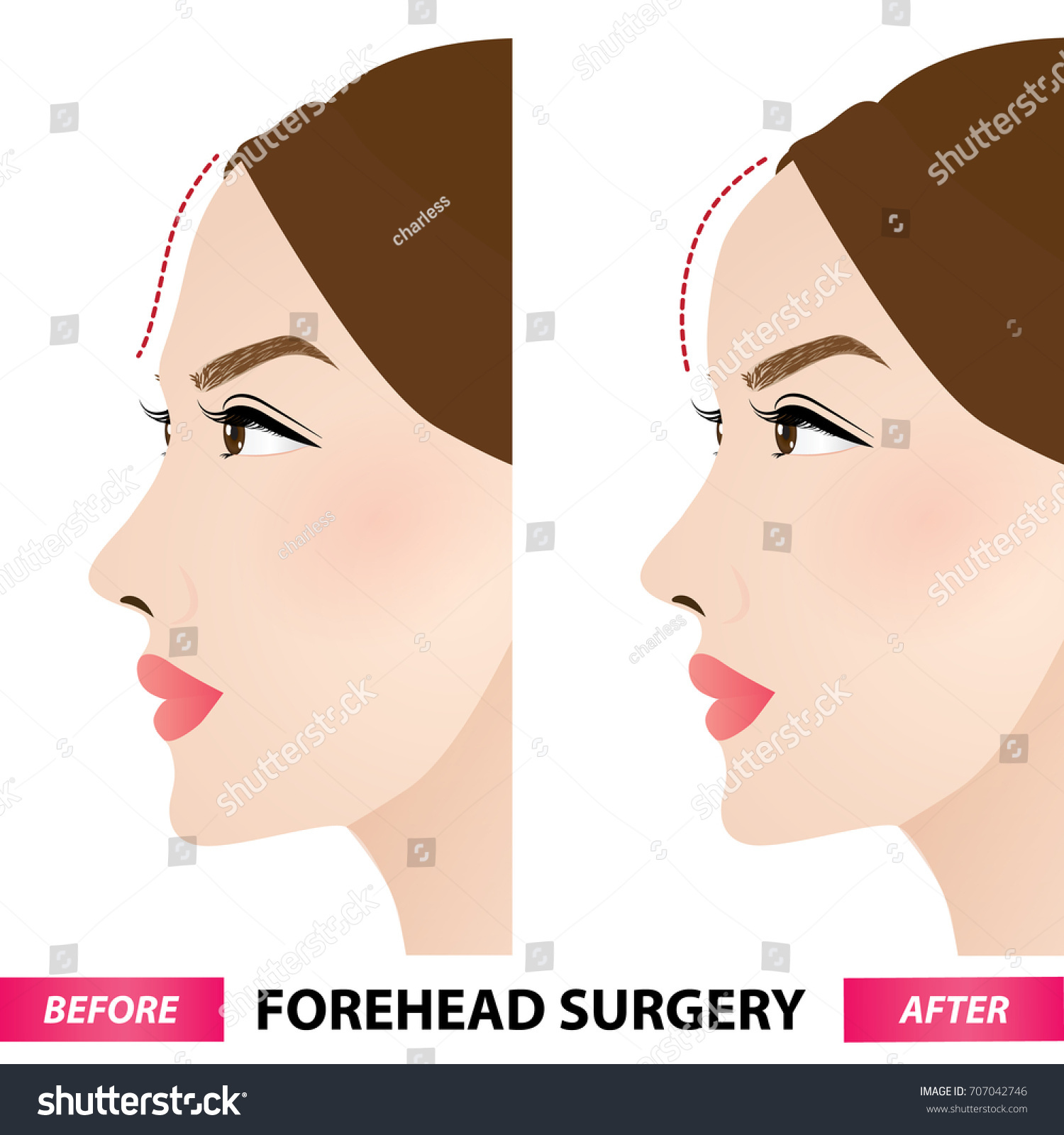 Vektor Stok Forehead Surgery Before After Vector Illustration (Tanpa ...