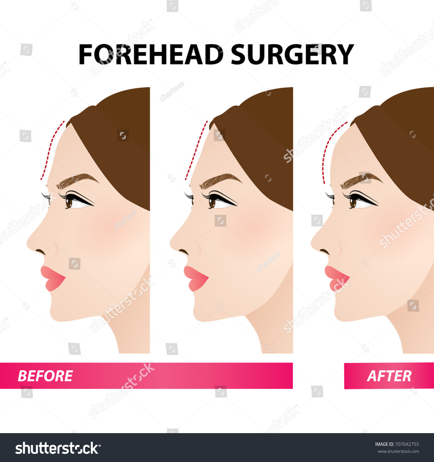 Forehead Surgery Before After Vector Illustration: เวกเตอร์สต็อก (ปลอด ...